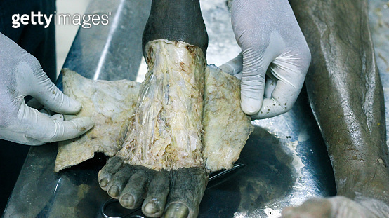Anatomy dissection of a cadaver showing dorsum of foot using scalpel ...