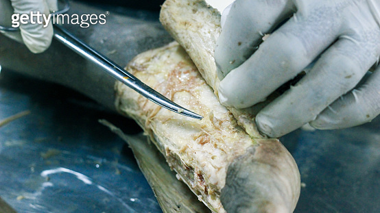 Anatomy dissection of a cadaver showing dorsum of foot using scalpel ...
