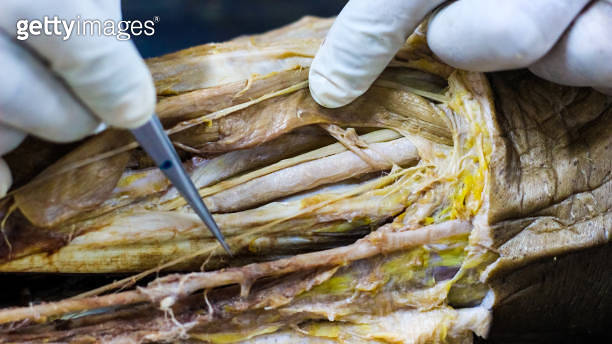 Anatomy dissection of a cadaver showing adductor canal using scalpel ...