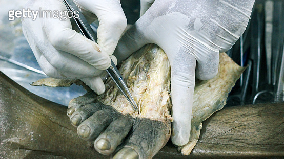 Anatomy dissection of a cadaver showing dorsum of foot using scalpel ...
