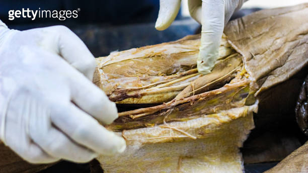 Anatomy dissection of a cadaver showing adductor canal using scalpel ...