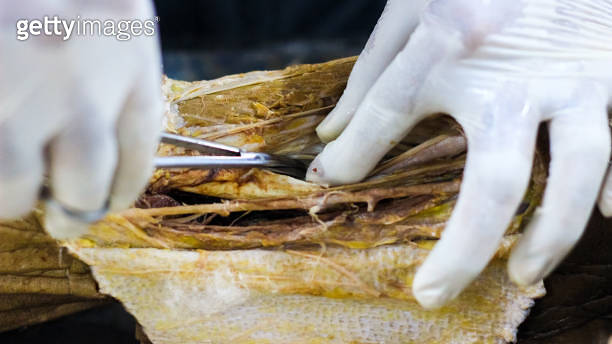 Anatomy dissection of a cadaver showing adductor canal using scalpel ...