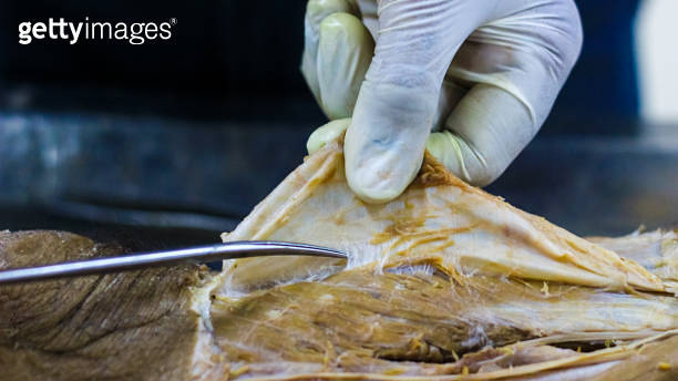 Anatomy dissection of a cadaver showing adductor canal using scalpel ...