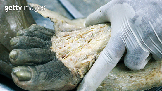 Anatomy dissection of a cadaver showing dorsum of foot using scalpel ...