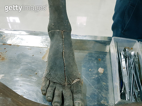 Anatomy dissection of a cadaver showing dorsum of foot using scalpel ...