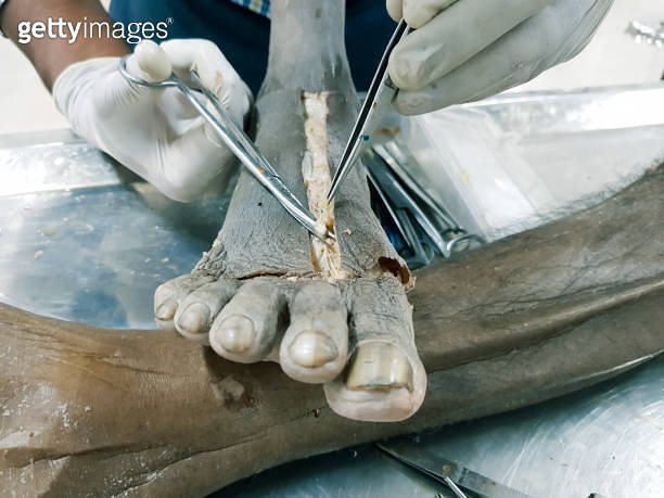 Anatomy dissection of a cadaver showing dorsum of foot using scalpel ...