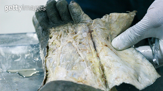Anatomy dissection of a cadaver showing dorsum of foot using scalpel ...