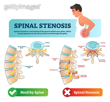 Spinal stenosis vector illustration. Labeled medical scheme with ...