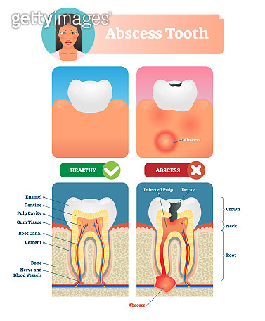 Abscess tooth vector illustration. Labeled medical diagram with ...