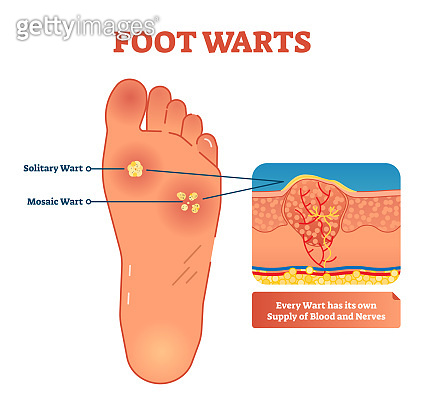 Foot warts vector illustration. Medical scheme with solitary and mosaic ...