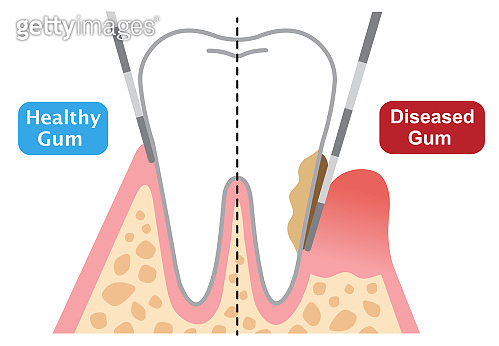 periodontal probing depth showing healthy and diseased gum. dental and ...