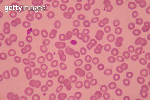 Large platelets on blood smear red blood cells background. (992719062 ...
