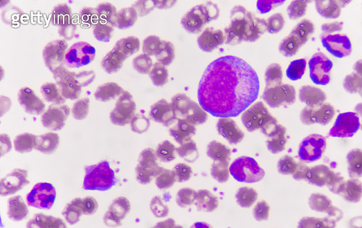 Immature blood cells in leukemia. 이미지 (987110738) - 게티이미지뱅크