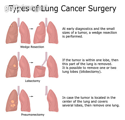 Types of Lung Cancer Surgery (1059125452) 일러스트, 무료 일러스트 - 게티이미지뱅크