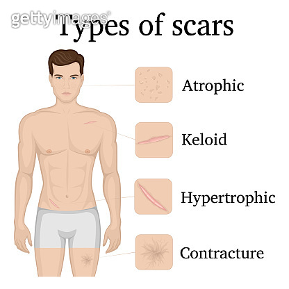 Illustration of the types of scars (1025954800) 일러스트, 무료 일러스트 - 게티이미지뱅크