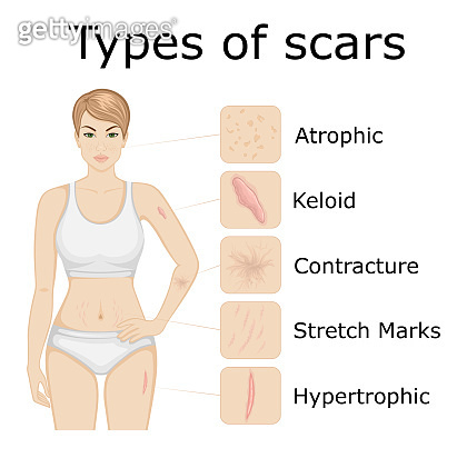 Types of scars (1011960686) 일러스트, 무료 일러스트 - 게티이미지뱅크