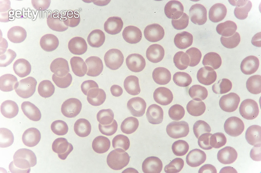 Target cells with abnormal red blood cells (943397774) - 게티이미지뱅크
