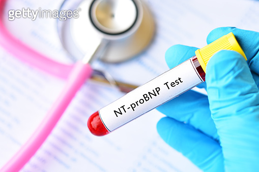 Blood sample for NT-proBNP test 이미지 (1060900522) - 게티이미지뱅크