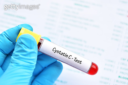 Blood sample tube for cystatin C test (1063334780) - 게티이미지뱅크