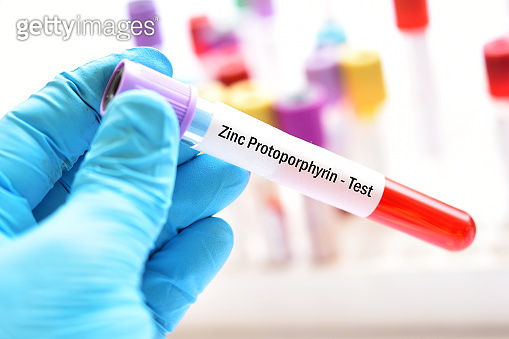 Blood sample for zinc protoporphyrin or ZPP test 이미지 (1048886988) - 게티이미지뱅크