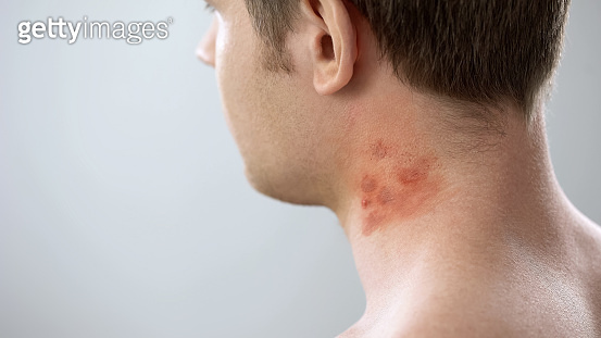 Red spots on male patient neck, bites of insects, allergy, contact ...
