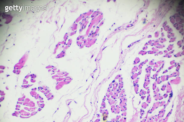 Atrophy of skeletal muscle human pathology sample under microscope ...