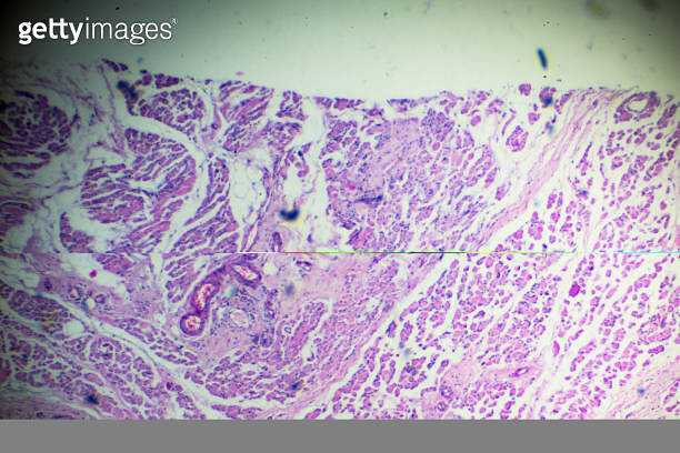 Atrophy of skeletal muscle human pathology sample under microscope ...