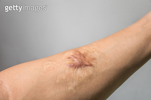 Close up Keloid scar (Hypertrophic Scar) on man arm skin after accident ...