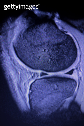 Magnetic resonance imaging MRI knee posterior horn medial meniscus tear ...