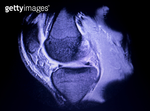 Magnetic resonance imaging MRI knee posterior horn medial meniscus tear ...