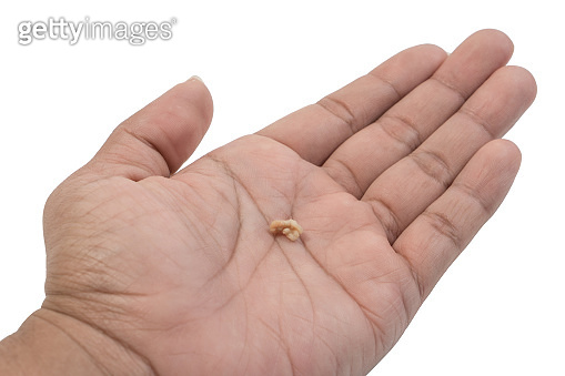 Tonsil Stone or Tonsillolith on the palm isolated on white background ...