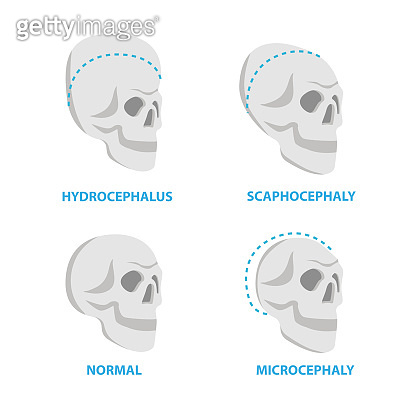 Set of Skulls normal and deformed, hydrocephalus, scaphocephaly ...