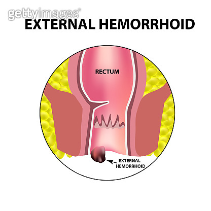 Hemorrhoids external. Rectum structure. Intestines. colon. Internal ...