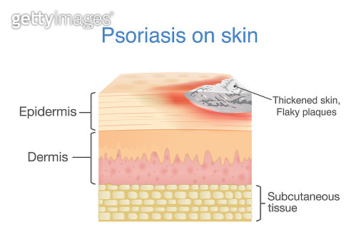 Human skin layer when plaque psoriasis signs and symptoms appear ...