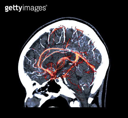 CT angiography of the brain sagittal view 3D Rendering image showing ...