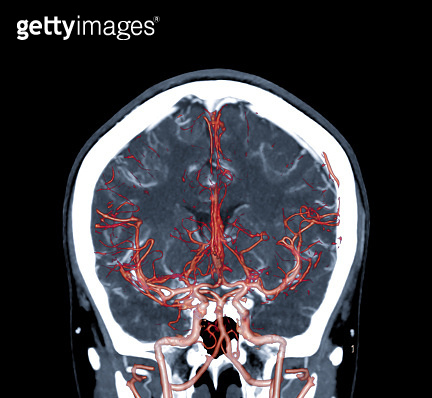 CT angiography of the brain coronal view 3D Rendering image show ...