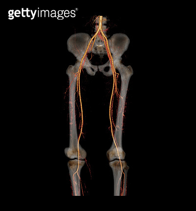 CT SCAN 2D and 3D rendering of lower extremity. (1005170832) - 게티이미지뱅크