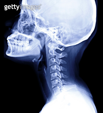 x-ray image of cervical spine or neck Lateral view or side view ...