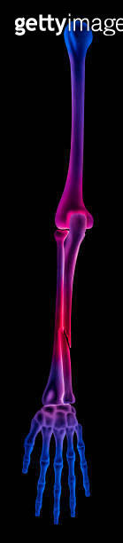 X-ray of ulna fracture or Broken Arms red highlight on pain area ...