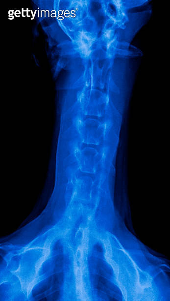 X-ray film of dog anterior view closed up in neck bone pain areas or ...