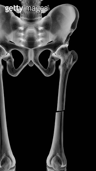 Broken upper leg bone- injury of thighbone or femur fracture completed ...