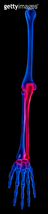 X-ray of human forearms bone anterior view -Red highlight in ulna bone ...