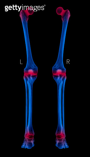 X-ray of Human Leg bone posterior view red highlights in arthritis leg ...