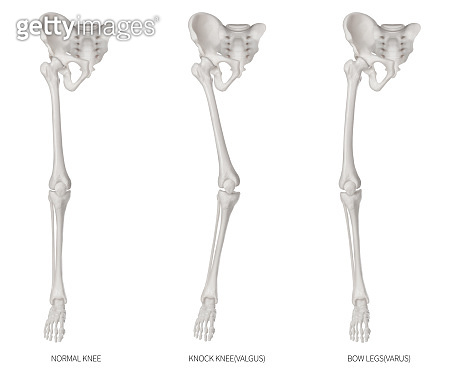 Types disease of lower half limbs or leg bone problem- Normal- Knock ...