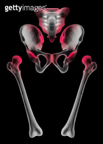 X-ray of separate human hip and femur bone anterior view red highlight ...