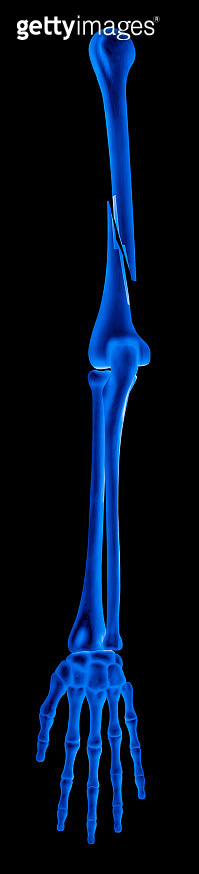 X-ray of the humerus fractures or broken arms completed displaced ...