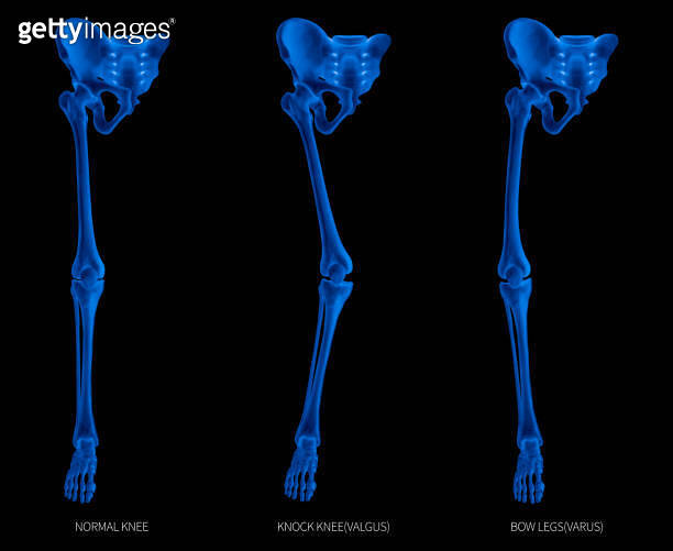 Types disease of lower half limbs or leg bone problem- normal-knock ...