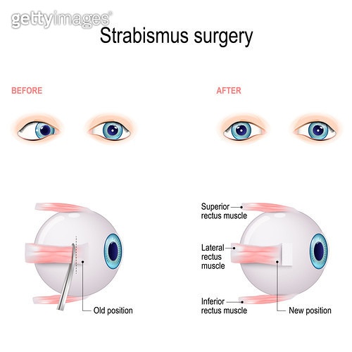 Strabismus Surgery. Eye muscle recession. Extraocular Muscle Anatomy ...