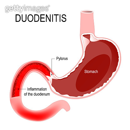 Duodenitis. Stomach and duodenum with inflammation. Human anatomy ...