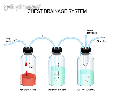 Chest drainage system 이미지 (914515946) - 게티이미지뱅크